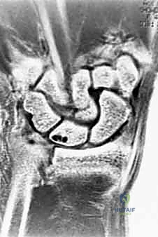 Darrach Procedure: Distal Ulnar Resection Masterclass | Guide Chapter