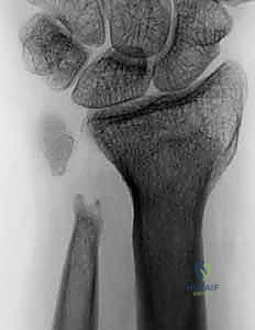 Darrach Procedure: Distal Ulnar Resection Masterclass | Guide Chapter