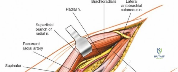 Anterolateral Approach to the Elbow: Surgical Guide