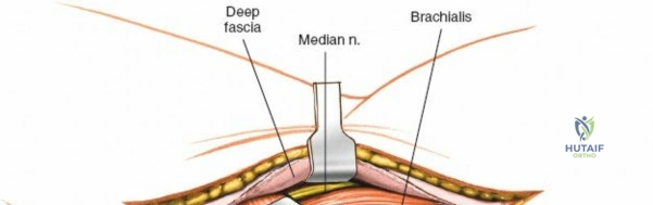 Anteromedial Elbow Approach: Anatomy & Surgical Guide | Guide Chapter