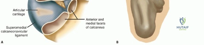 Spring Ligament Reconstruction: Regain Foot Stability | Guide Chapter